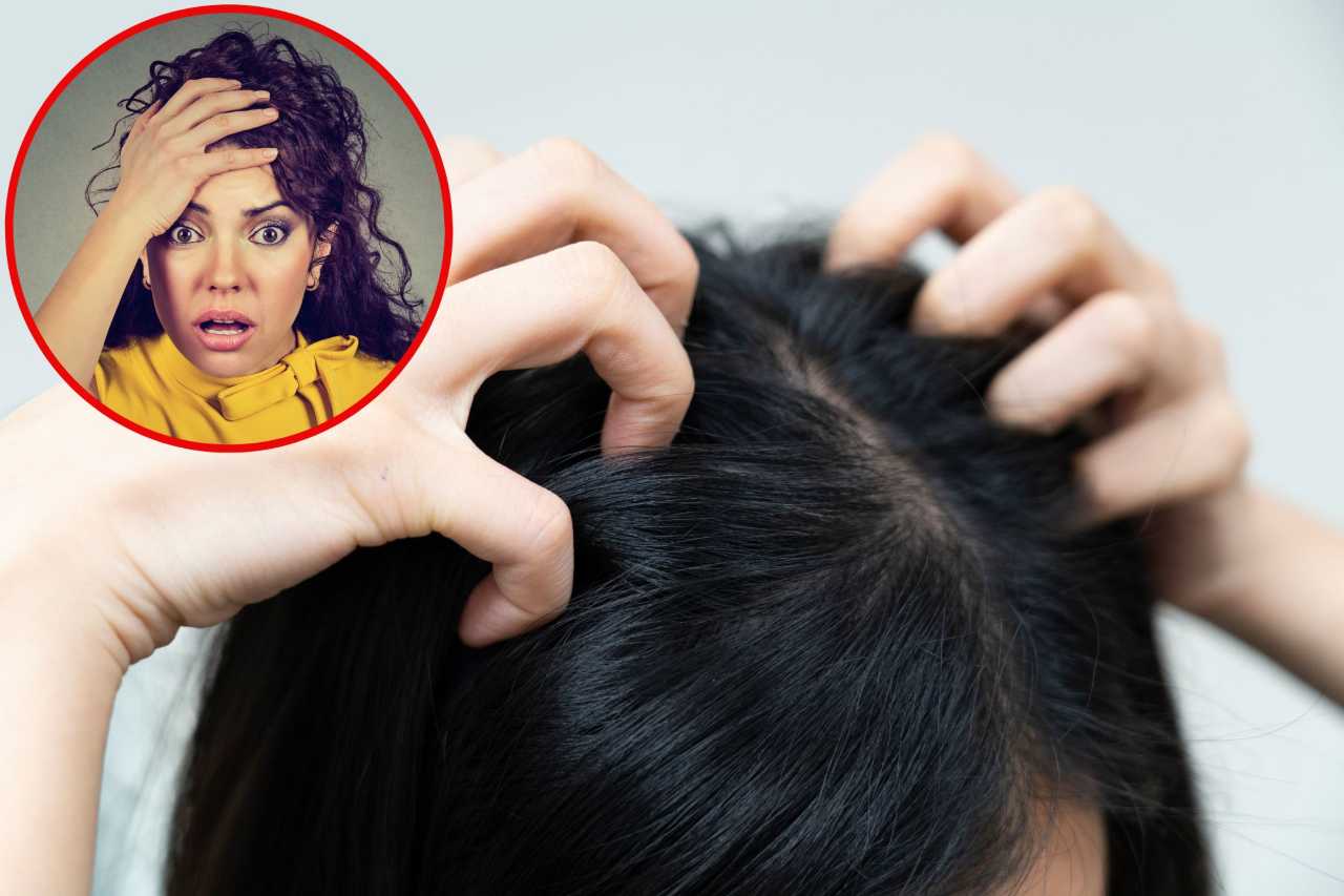 Croste in testa, non sono tutte uguali: ecco cosa possono determinare ...