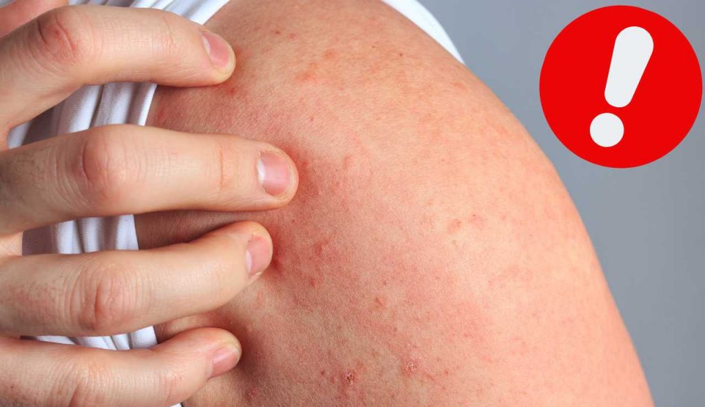 Macchie rosse sulla pelle, patologie spaventose: ecco cosa rischi ...