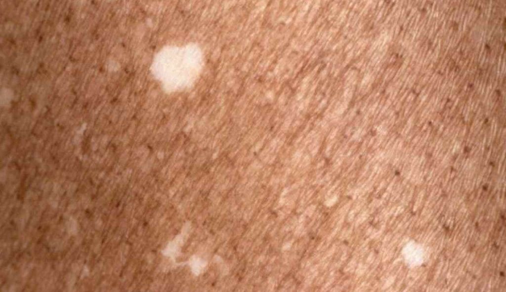 Macchie bianche sulla pelle: spuntano dall'abbronzatura | Quando ...